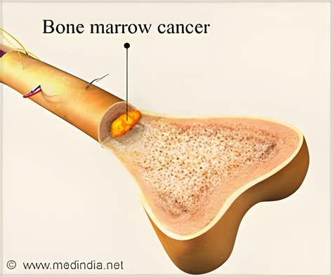 Bone Marrow Disease Is Stimulated By Vitamin D And Macrophages