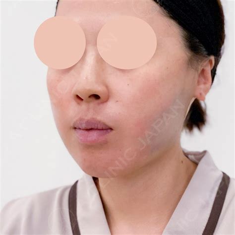 脂肪をたくさん取っても直後から腫れは最小限です！1day小顔脂肪吸引の処置前と処置直後の症例です40代女性 A Clinicは小顔