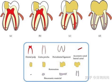牙髓发炎，只能做根管治疗吗？ 知乎