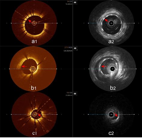 Frontiers Advantages Of Hybrid Intravascular Ultrasound Optical Coherence Tomography System In