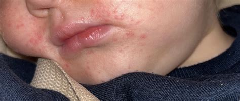 2 Year Old With Red Spots Around Mouth Mumsnet