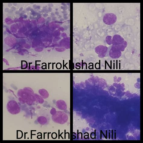 Farrokhshad Nili On Linkedin Fine Needle Aspiration Of Left Thyroid