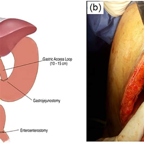 Hepaticojejunostomy With Gastric Access Loop A Illustrative Diagram B