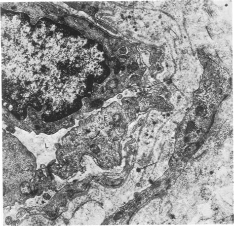 Figure From Gross And Ultrastructural Observations On Lesions Produced By Intradermal
