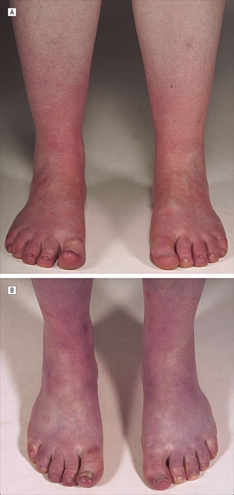 Between Episodes Of Erythromelalgia A Spectrum Of Colors Cardiology