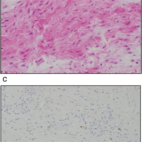 Pseudomembranous Candidiasis Download Scientific Diagram