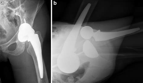 Late Anterior Prosthetic Hip Dislocation Due To Yoga Arthroplasty Today