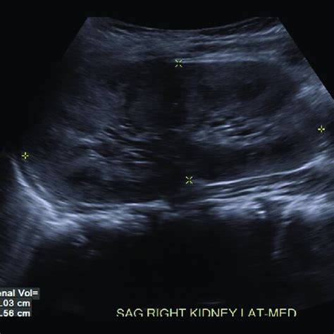 Transverse Sonographic Image Of The Liver In The Periportal Region Download Scientific Diagram
