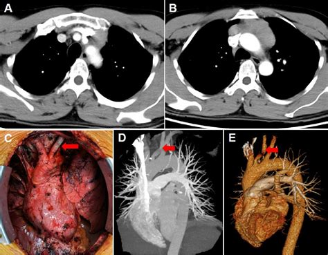Pdf An Extremely Rare Case Of Primary Anterior Mediastinal Tumor