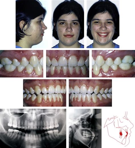 Multiloop Edgewise Archwire In The Treatment Of A Patient With An