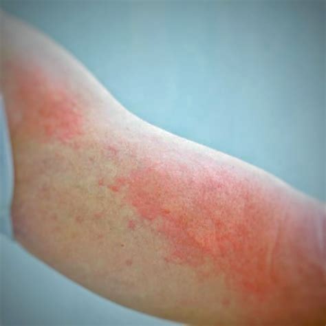 Urticaria Crónica Afecta Al 20 De La Población Mundial Diario Avance
