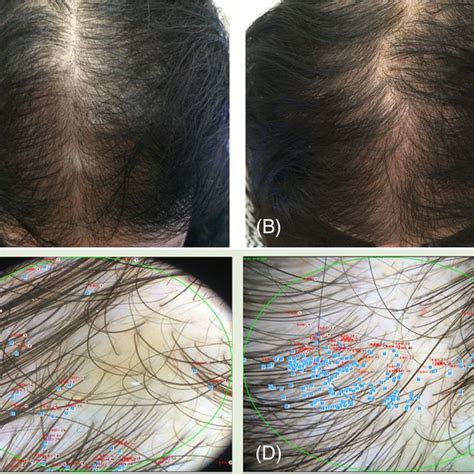 Clinical Pictures Of A 25‐year‐old Female With Fphl Grade I A At