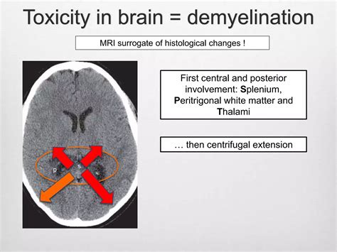 X Linked Adrenoleukodystrophy Radiological Assessment Pptx