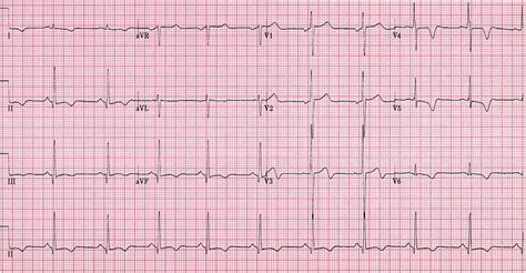 Syncope Medicine Wikiwand