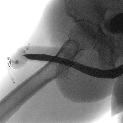 Antegrade Urethrogram Of The Patient Shows An Obliterative Stricture Of