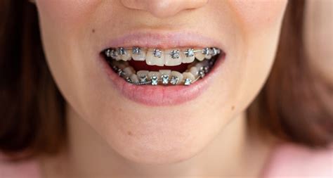 Overbite Correction