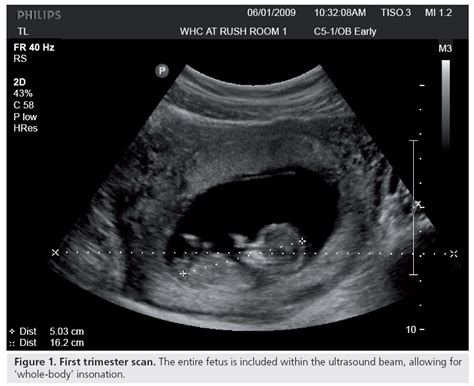 Ultrasound Imaging Of The Early Fetus Is It Safe