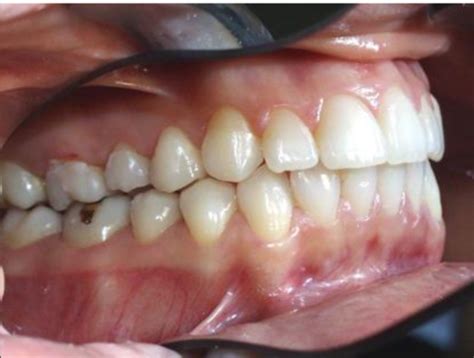 Lecture 2 Occlusal Classifications Angle Flashcards Quizlet