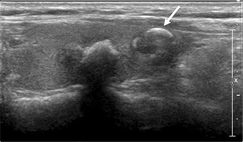 Echogenic Foci Associated With Malignancy 70 Year Old Female With Download Scientific Diagram