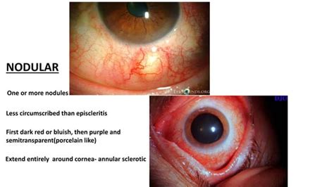 Episcleritis And Scleritis Pptx Eye And Vision Conditions