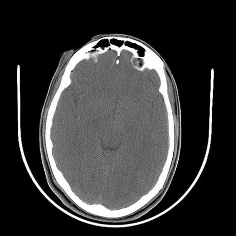 Dicom Skull Head And Neck Cts