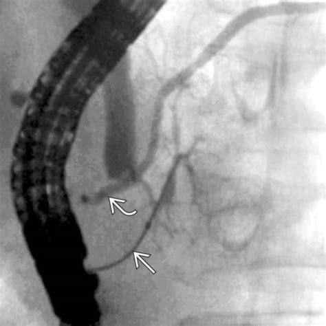 Pancreatic Divisum Ercp