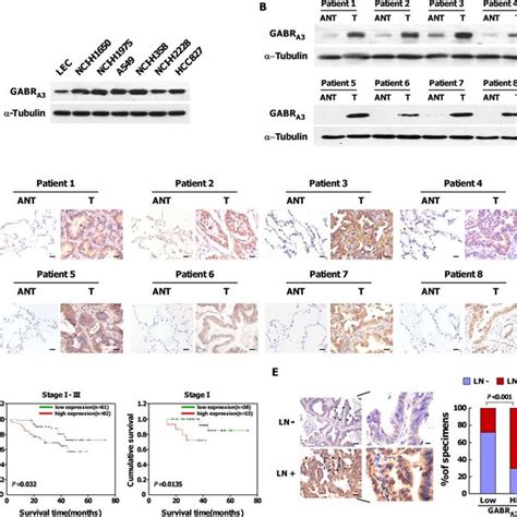 Upregulation Of Gabr A3 Correlates With Poor Prognosis In Luad A