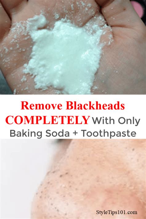 Remove Blackheads In Only 10 Minutes