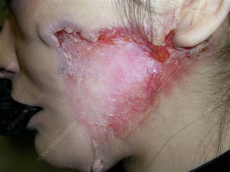 Pyoderma Gangrenosum Treated With Infliximab Stock Image C056 5064 Science Photo Library