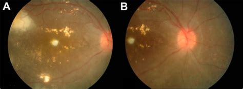 Fundus Finding At 14 Months Post Retinal Laser Photocoagulation At