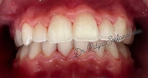 Finished Orthodontic Treatment Of Class 2 Subdivision 1 No Extraction