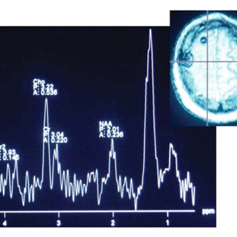 A Magnetic Resonance Spectroscopy Scan Focusing On One Volume Element