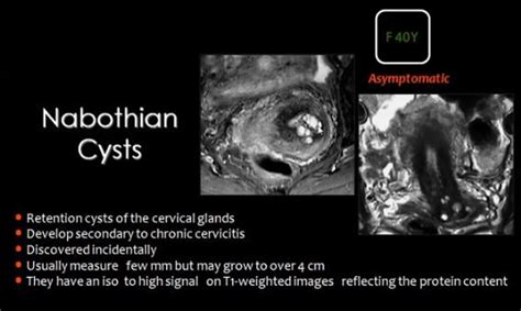 Cervicitis Ultrasound
