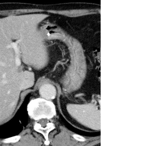 Endoscopic Findings A Duodenal Polyp 2 Cm On The Bulb Portion With A