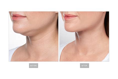 4 In 1 Ret Face Ems Rf Muscle Stimulation Face Lift Machine Konmison