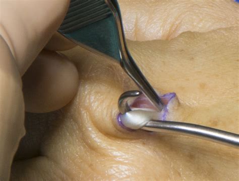 Technique Eip To Epl Tendon Transfer Luanmd