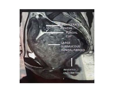 Chronic Non Peurperal Uterine Inversionrecommendations For Diagnosis