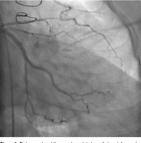 Structure Of Anterior Interventricular Sulcus Semantic Scholar