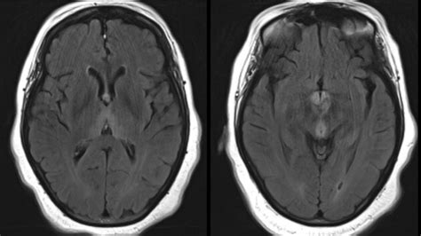 Devic S Disease Of Signs