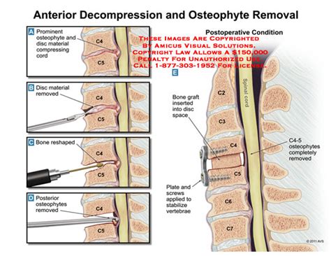 Amicus Illustration Of Amicussurgerycervicalspineanterior