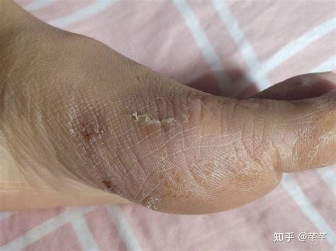 脚气怎么治才能除根？用这个小技巧，10分钟有感觉 知乎