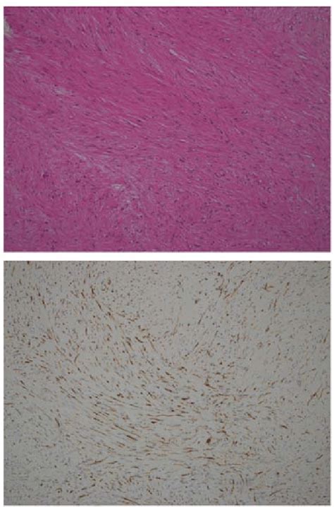 Leiomyoma A Leiomyoma Composed Of Intersecting Fascicles Of