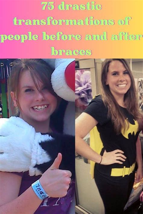 Braces Before After Artofit