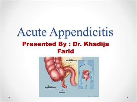 Acute Appendicitis Pptx