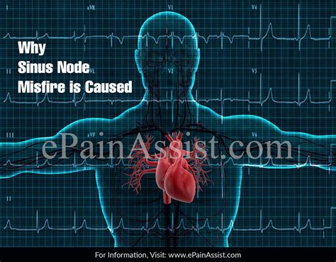 Sinus Node Disease Or Sinus Node Dysfunctioncausessymptomstreatment