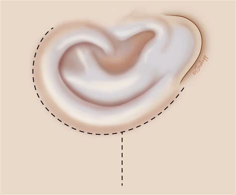 External Ear Ento Key