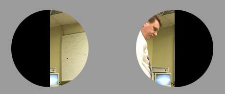 Visual Field Defects Ophthalmology Medbullets Step