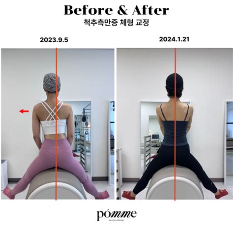 안양 척추측만 교정 필라테스 유방암 수술 후 생긴 측만 네이버 블로그