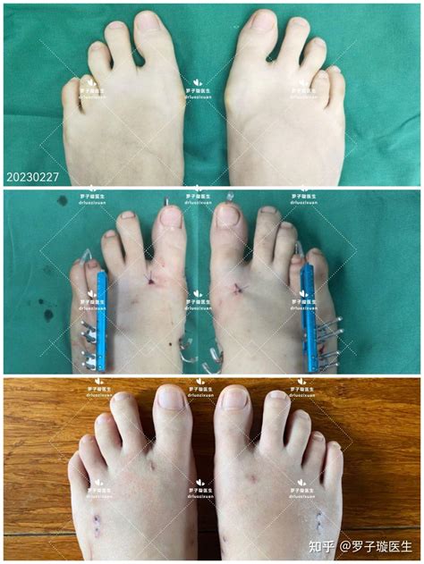 各种类型短趾症（脚趾短小症）术前术后对比。 持续更新中，20240513 知乎