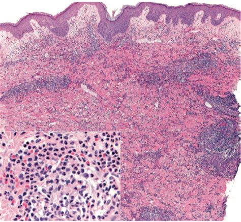 Polymorphous Light Eruption Histology